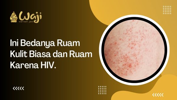 Perbedaan Ruam Kulit Biasa dan HIV, Cek Cara Mudah Membedakannya